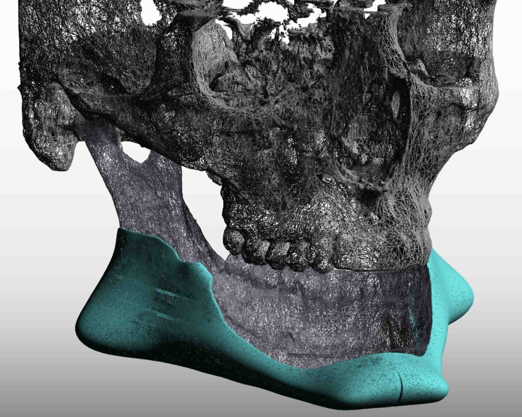 Plastic Surgery Case Study - Secondary Custom Jawline Implant ...