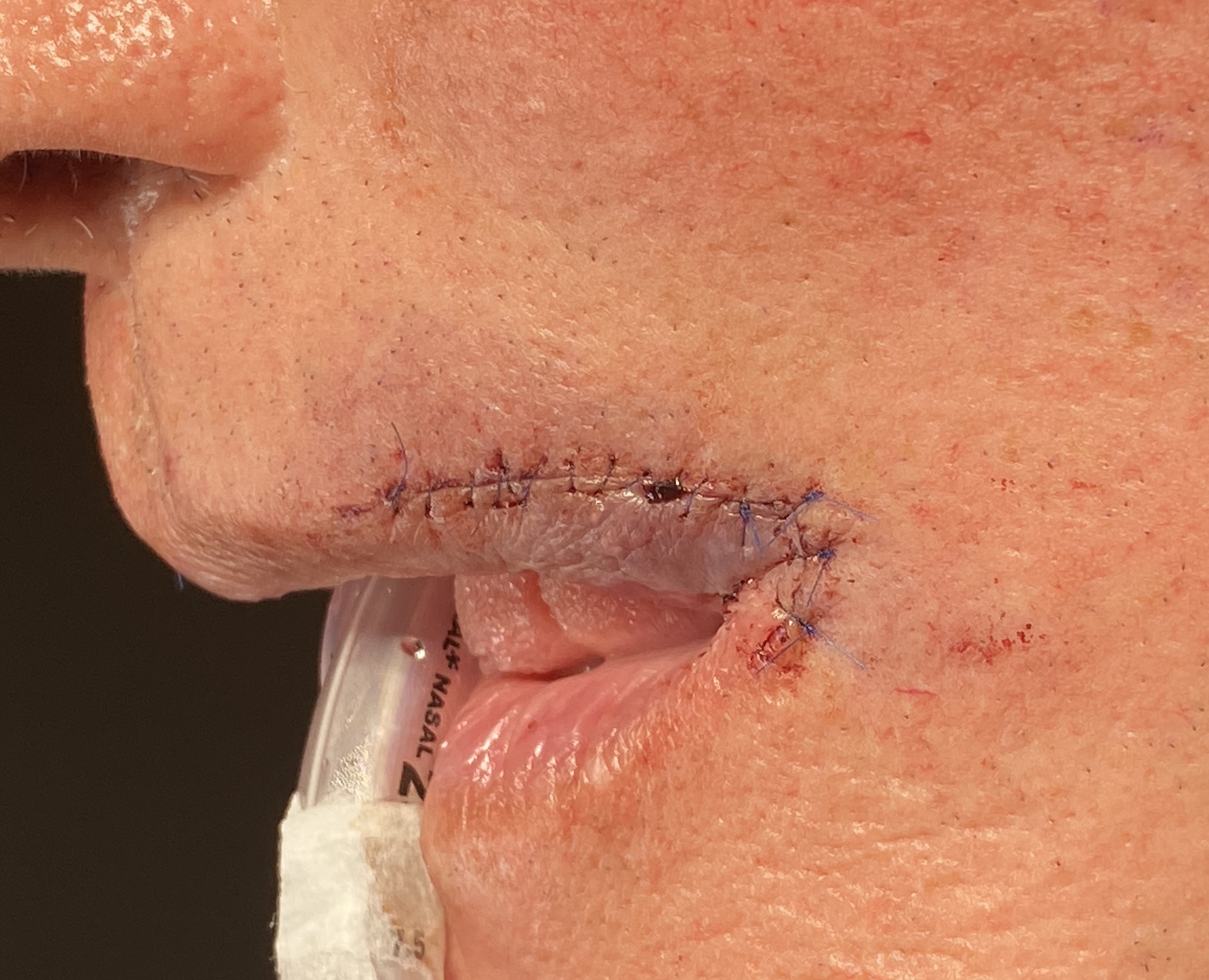 left extended corner of mouth lift 2 Dr Barry Eppley - Explore Plastic ...