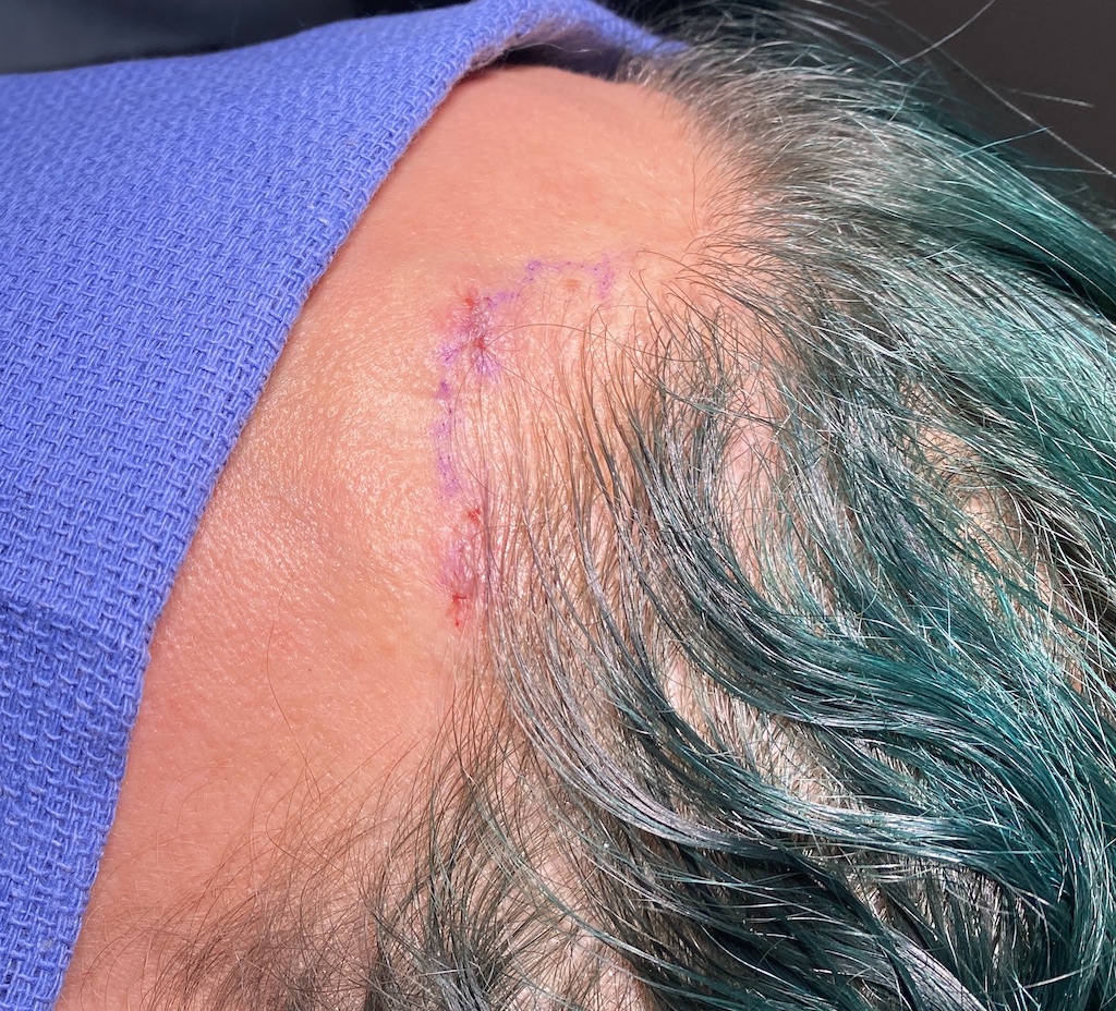 left temporal artery ligations completed Dr Barry Eppley - Explore ...