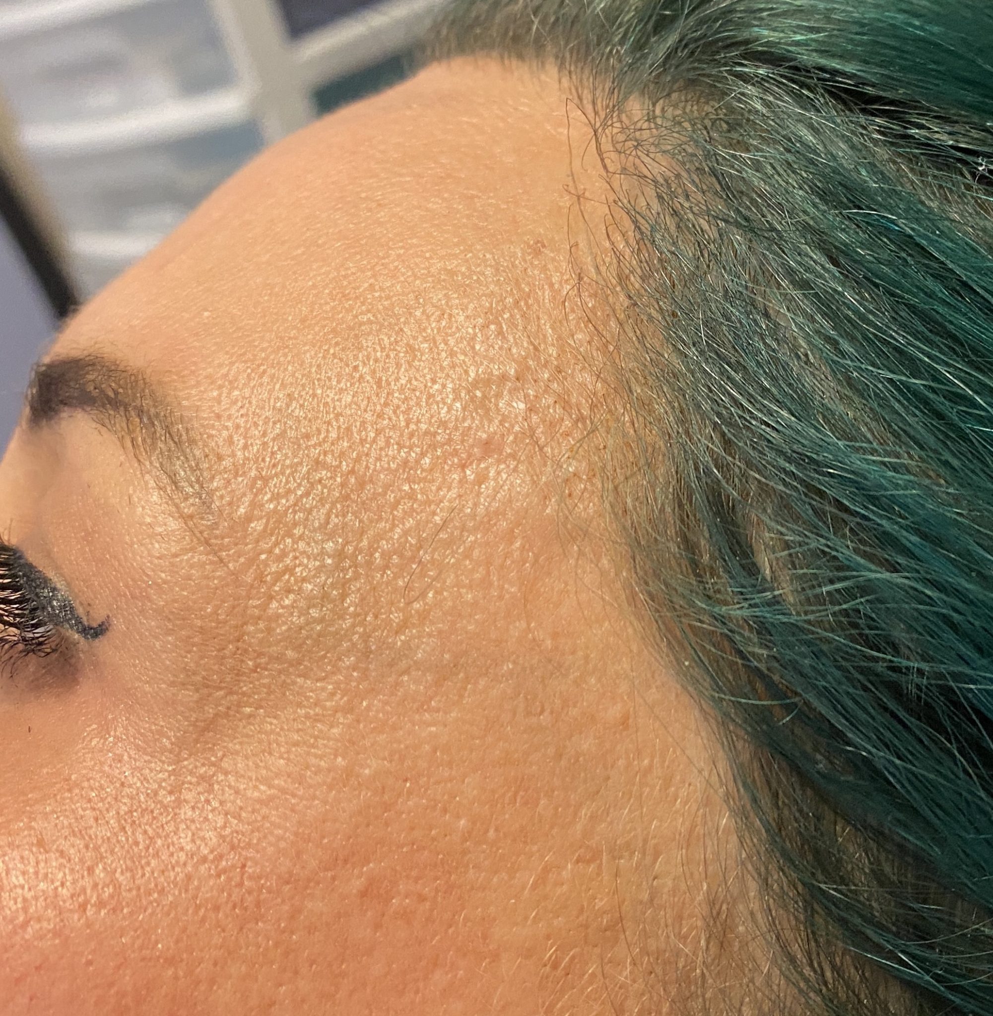 Plastic Surgery Case Study - Reduction of Prominent Female Temporal ...