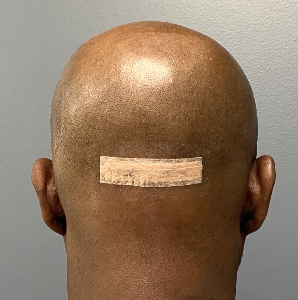 Plastic Surgery Case Study - Custom Skull Implant Augmentation for Male ...