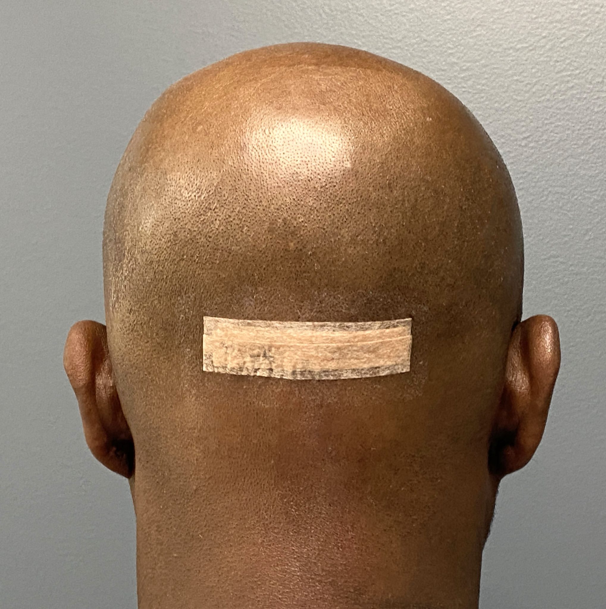 Plastic Surgery Case Study - Custom Skull Implant Augmentation for Male ...