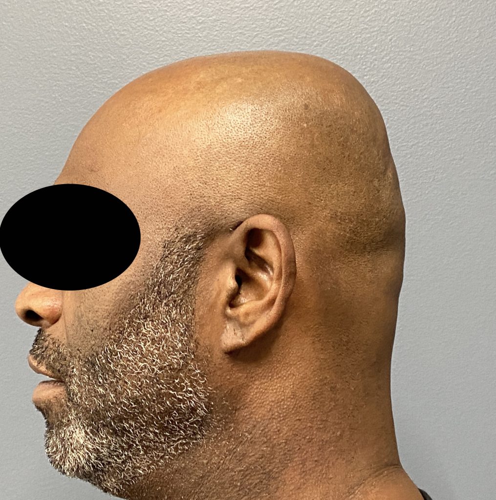 Plastic Surgery Case Study - Custom Skull Implant Augmentation for Male Flat Back of the Head ...
