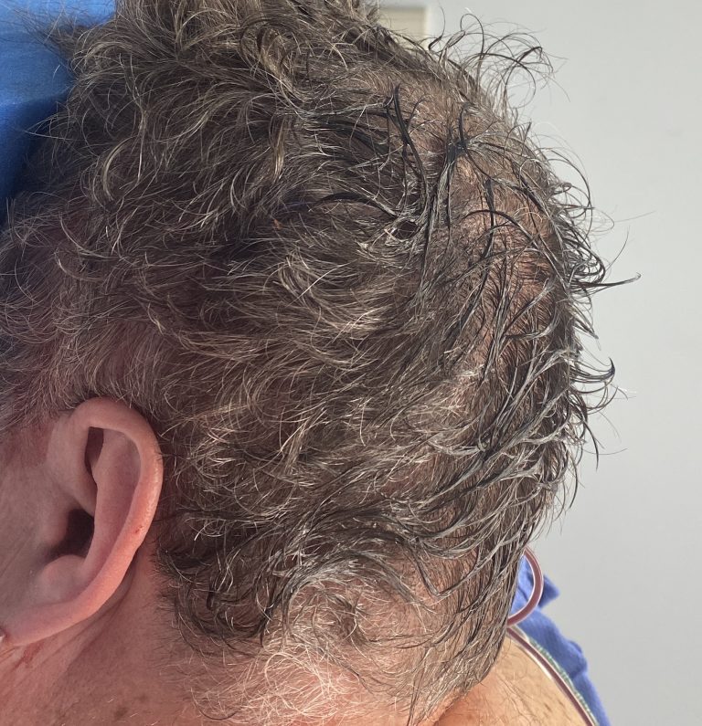 Plastic Surgery Case Study - Increasing the Curvature of the Flat Back ...