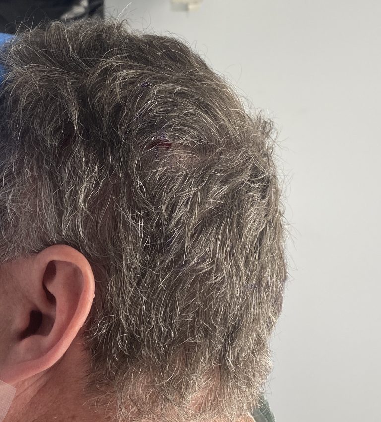 Plastic Surgery Case Study - Increasing the Curvature of the Flat Back ...