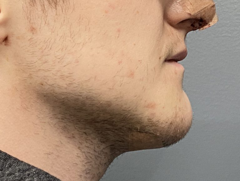 Plastic Surgery Case Study - Reduction of the Large Horizontal ...