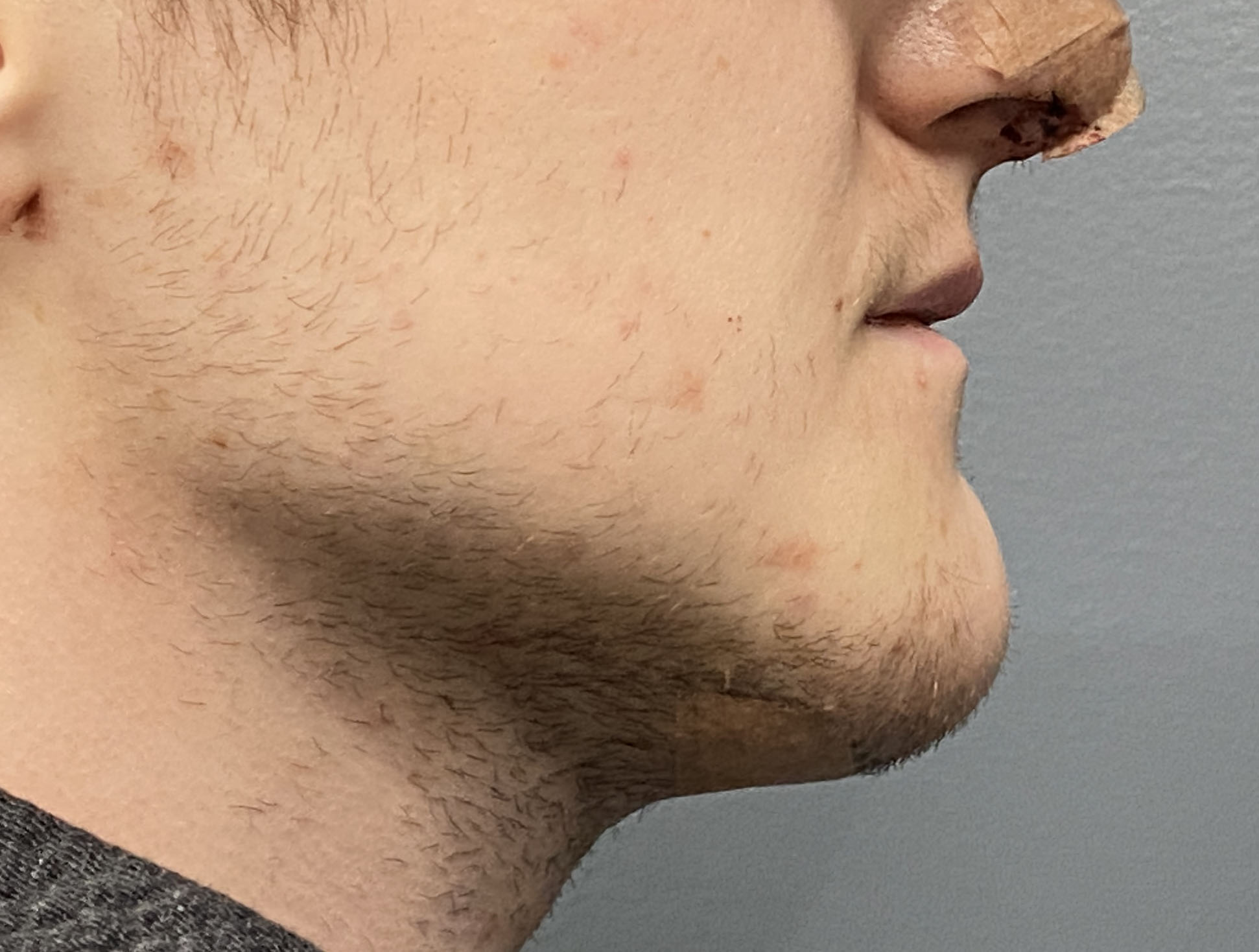 Plastic Surgery Case Study - Reduction of the Large Horizontal ...