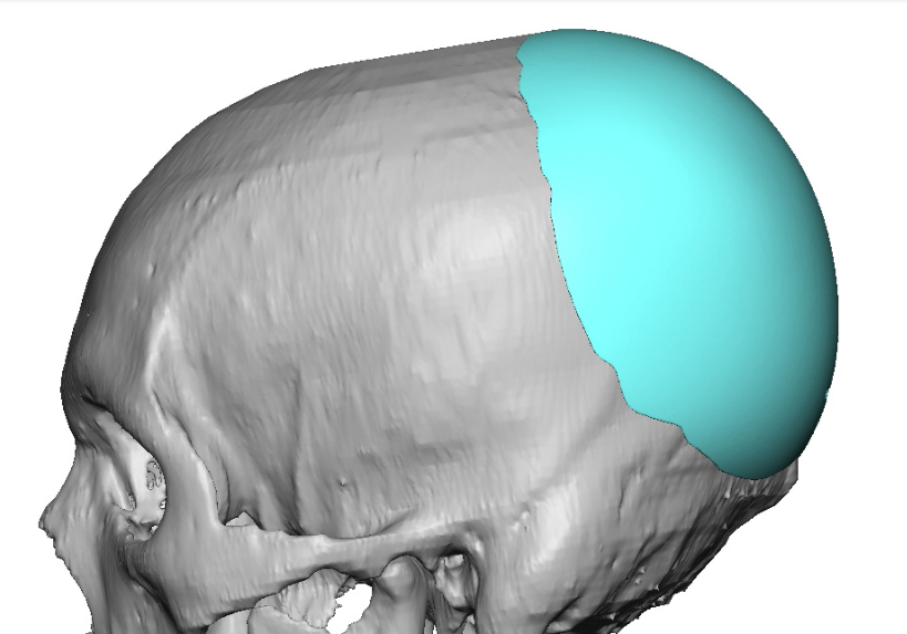 Plastic Surgery Case Study - Custom Skull Implant Augmentation for Male ...