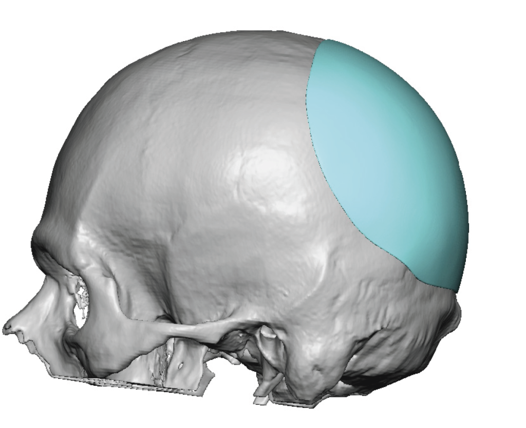 Plastic Surgery Case Study - Increasing the Curvature of the Flat Back ...