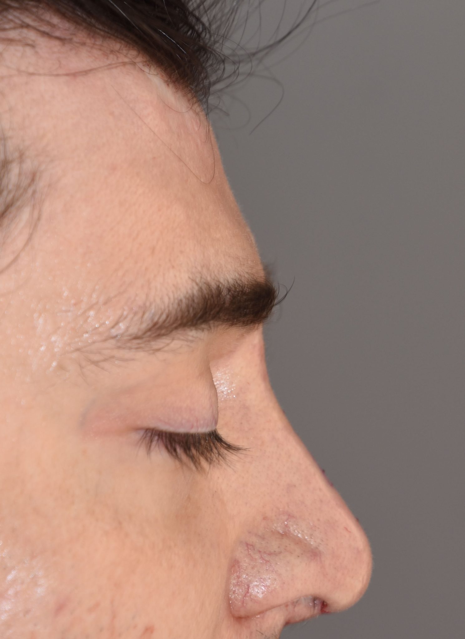 Plastic Surgery Case Study - Custom Forehead Implant Augmentation in the Short Male Forehead ...