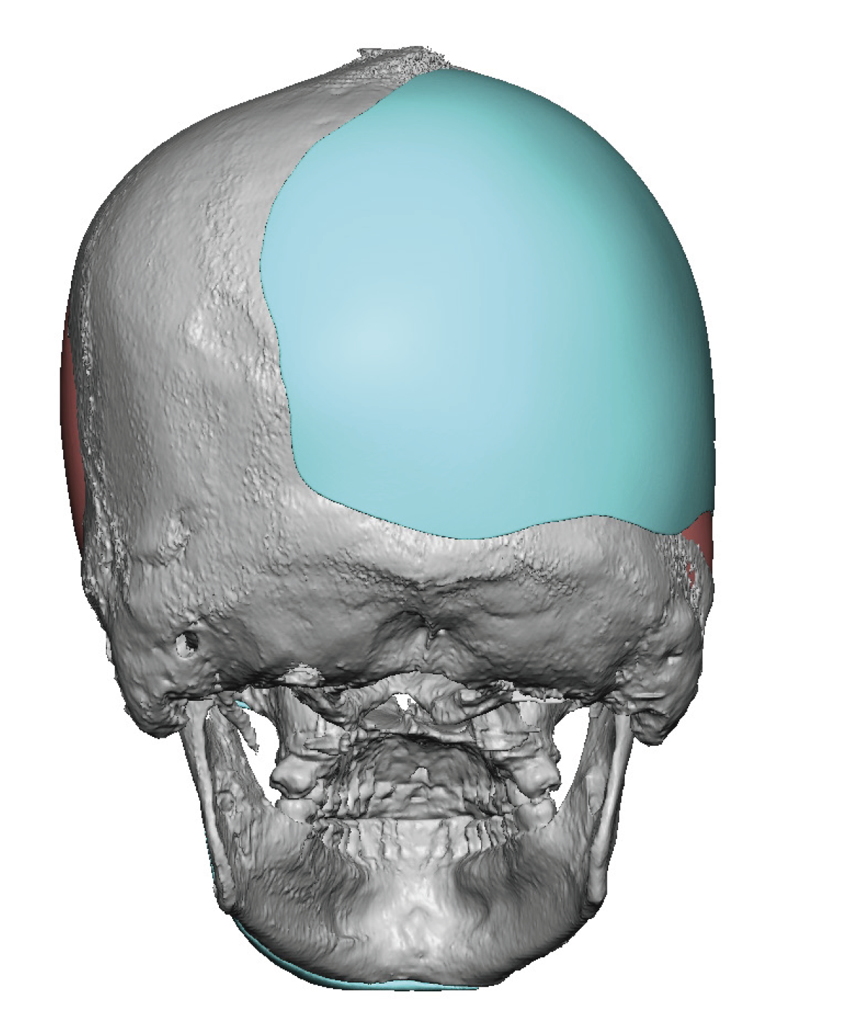 Plastic Surgery Case Study - Comprehensive Craniofacial Asymmetry ...
