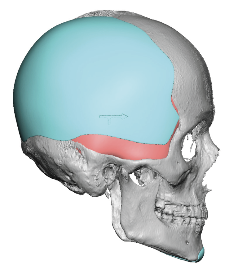 Plastic Surgery Case Study - Comprehensive Craniofacial Asymmetry ...