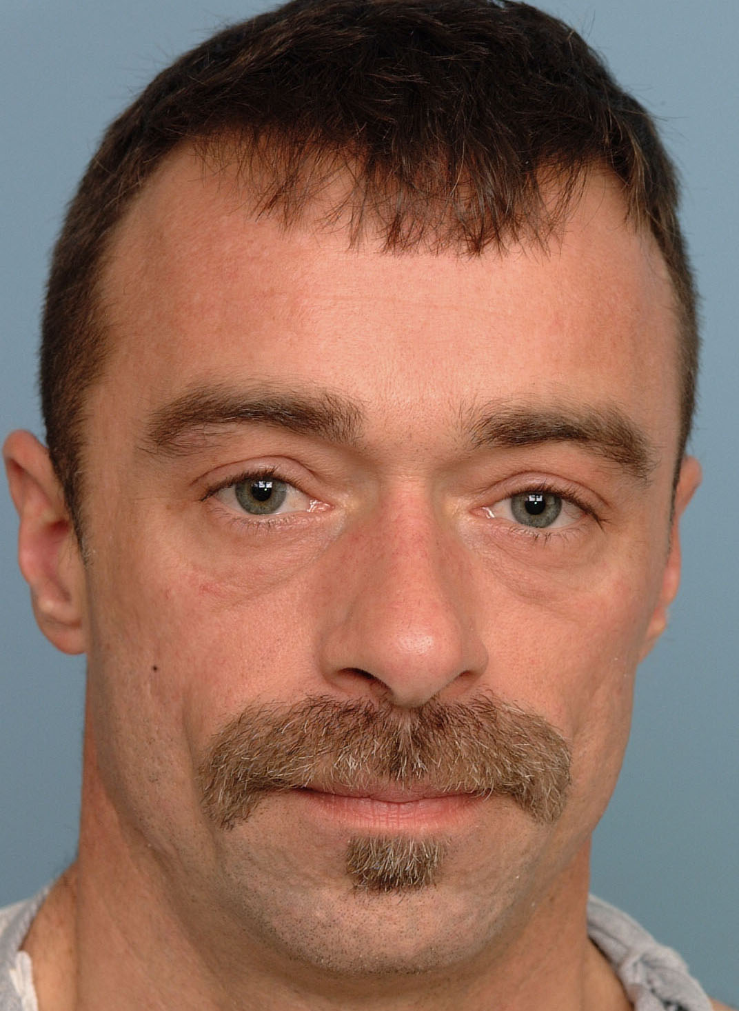 Plastic Surgery Case Study - Long Term Effects of Submalar Cheek ...