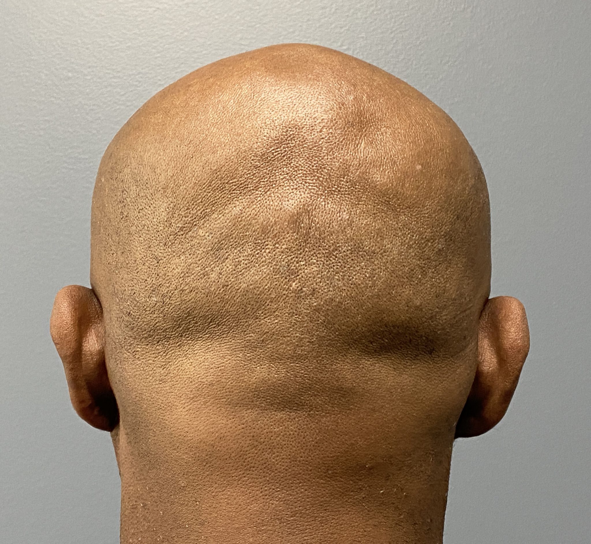 Plastic Surgery Case Study - Custom Skull Implant Augmentation for Male ...