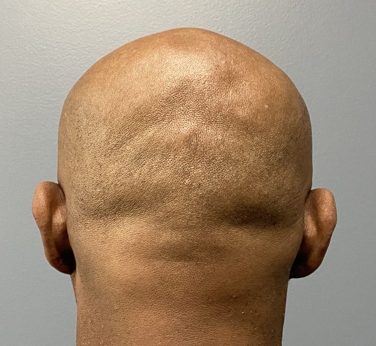 Plastic Surgery Case Study - Custom Skull Implant Augmentation for Male ...