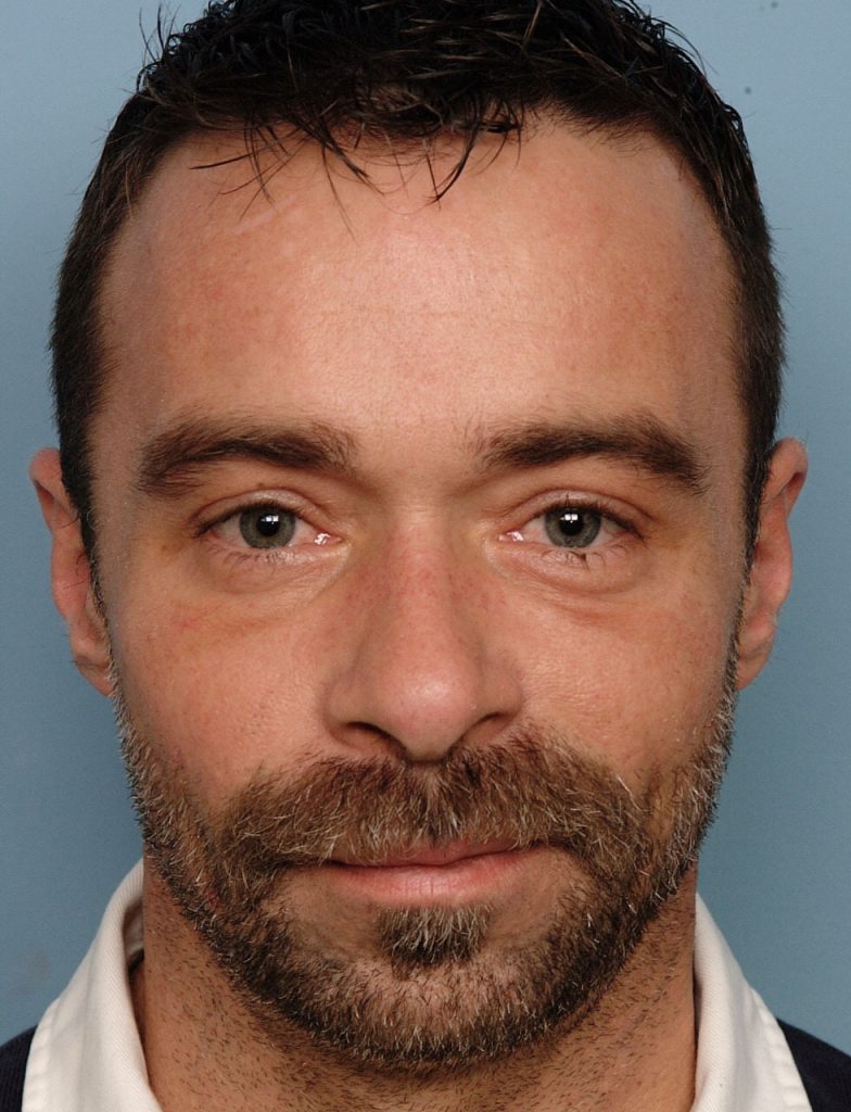 Plastic Surgery Case Study - Long Term Effects of Submalar Cheek ...