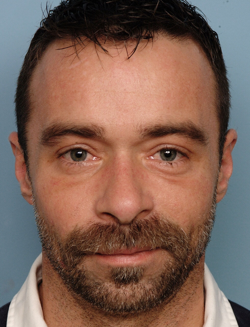 Plastic Surgery Case Study - Long Term Effects of Submalar Cheek ...