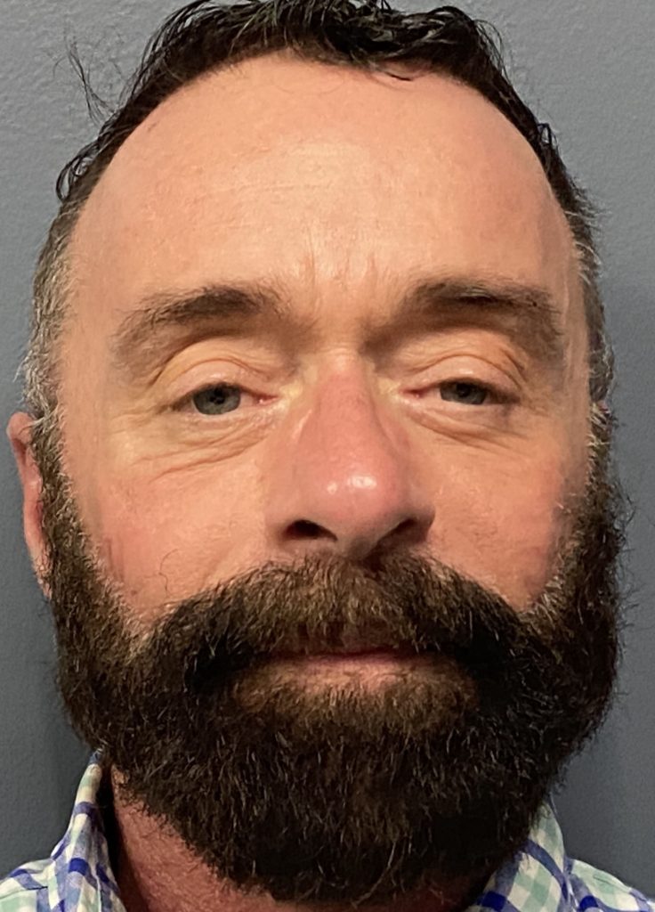 Plastic Surgery Case Study - Long Term Effects of Submalar Cheek ...