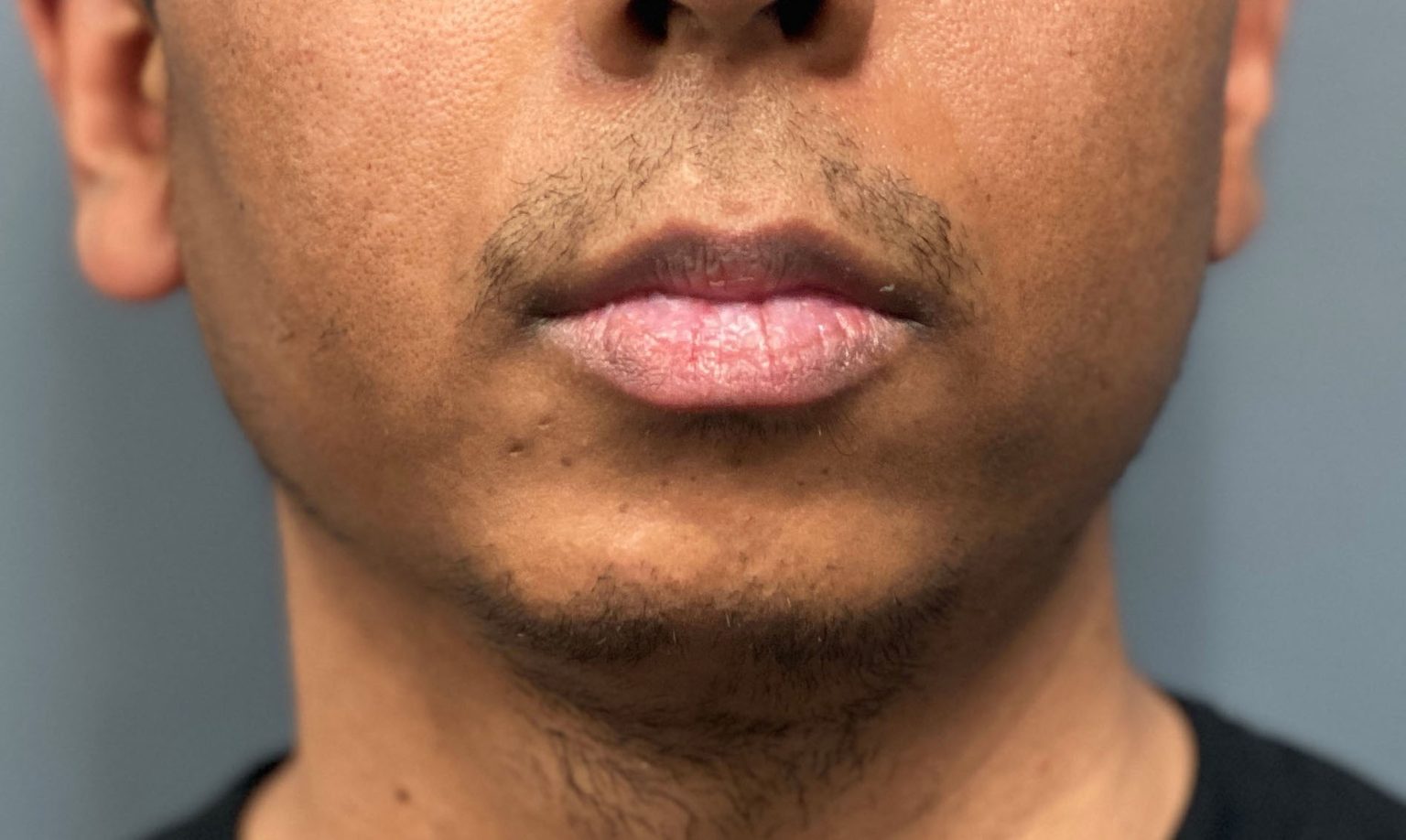 Plastic Surgery Case Study - Large Sliding Genioplasty Movements with ...