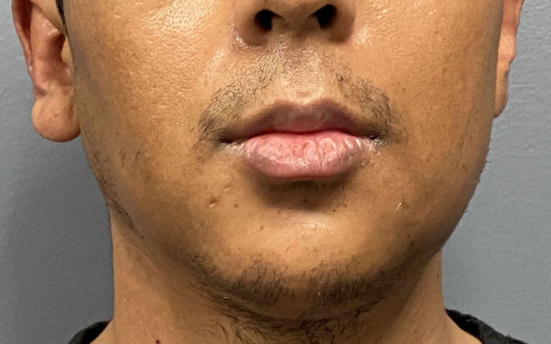 Plastic Surgery Case Study - Large Sliding Genioplasty Movements with ...