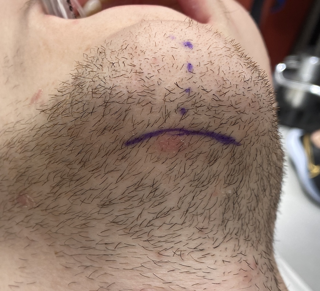 Plastic Surgery Case Study - Reduction of the Large Horizontal ...