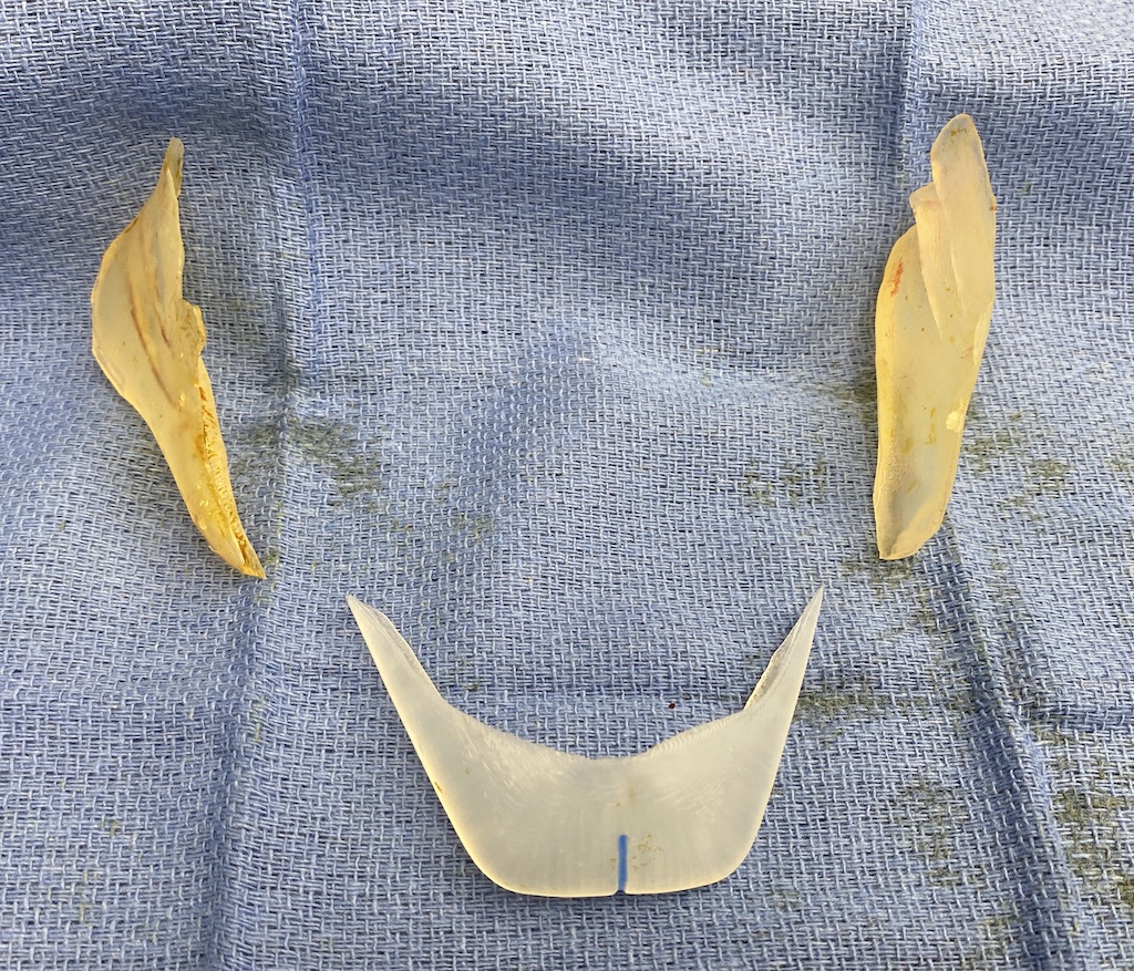 modified custom jawline implant with new custom chin implant intraop Dr ...