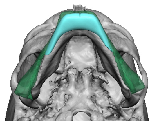 new custom chin implant combined with modified indwelling jawline ...