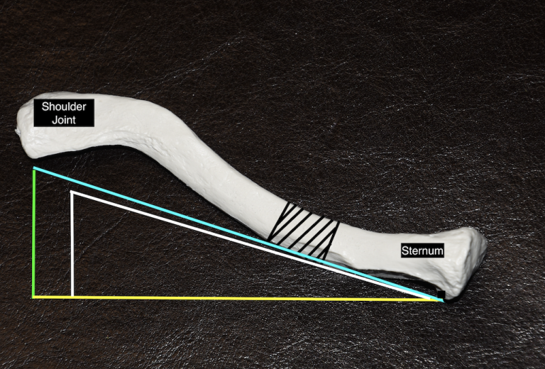 Evaluating the Inward Roll of the Shoulders from Clavicle Reduction ...