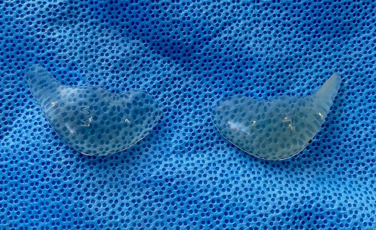 submalar cheek implants Dr Barry Eppley - Explore Plastic Surgery