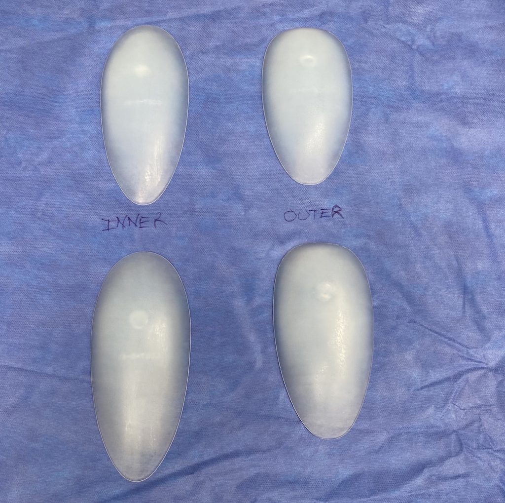 Plastic Surgery Case Study - The Four Calf Implant Approach for ...