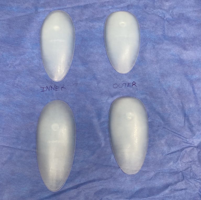 Plastic Surgery Case Study - The Four Calf Implant Approach for ...