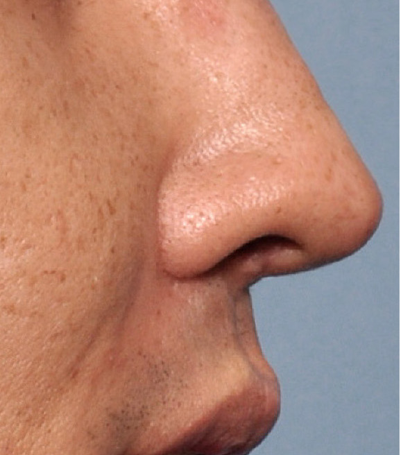 Custom Midface Implants for Improvement of Nasolabial Fold Depth ...