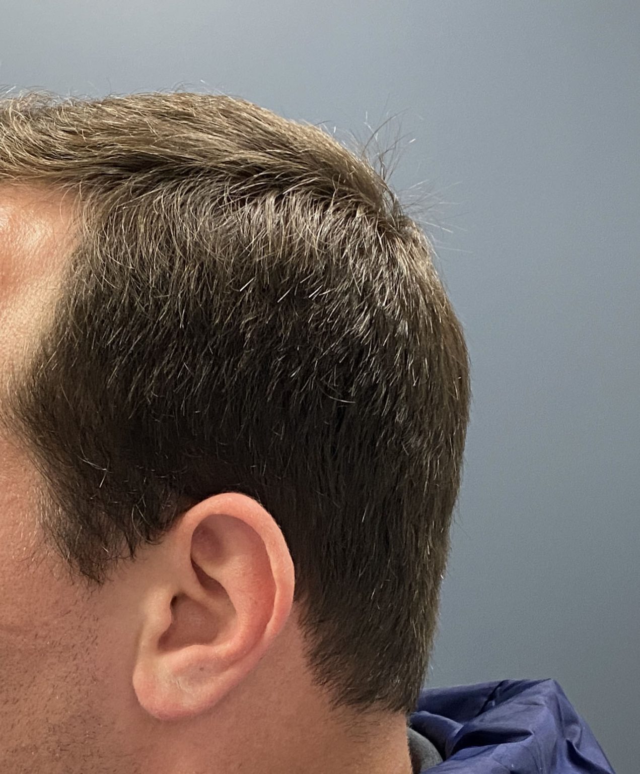 Plastic Surgery Case Study - Custom Skull Implant Augmentation for the ...