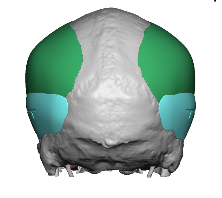 Plastic Surgery Case Study - Secondary Custom Posterior Temporal ...