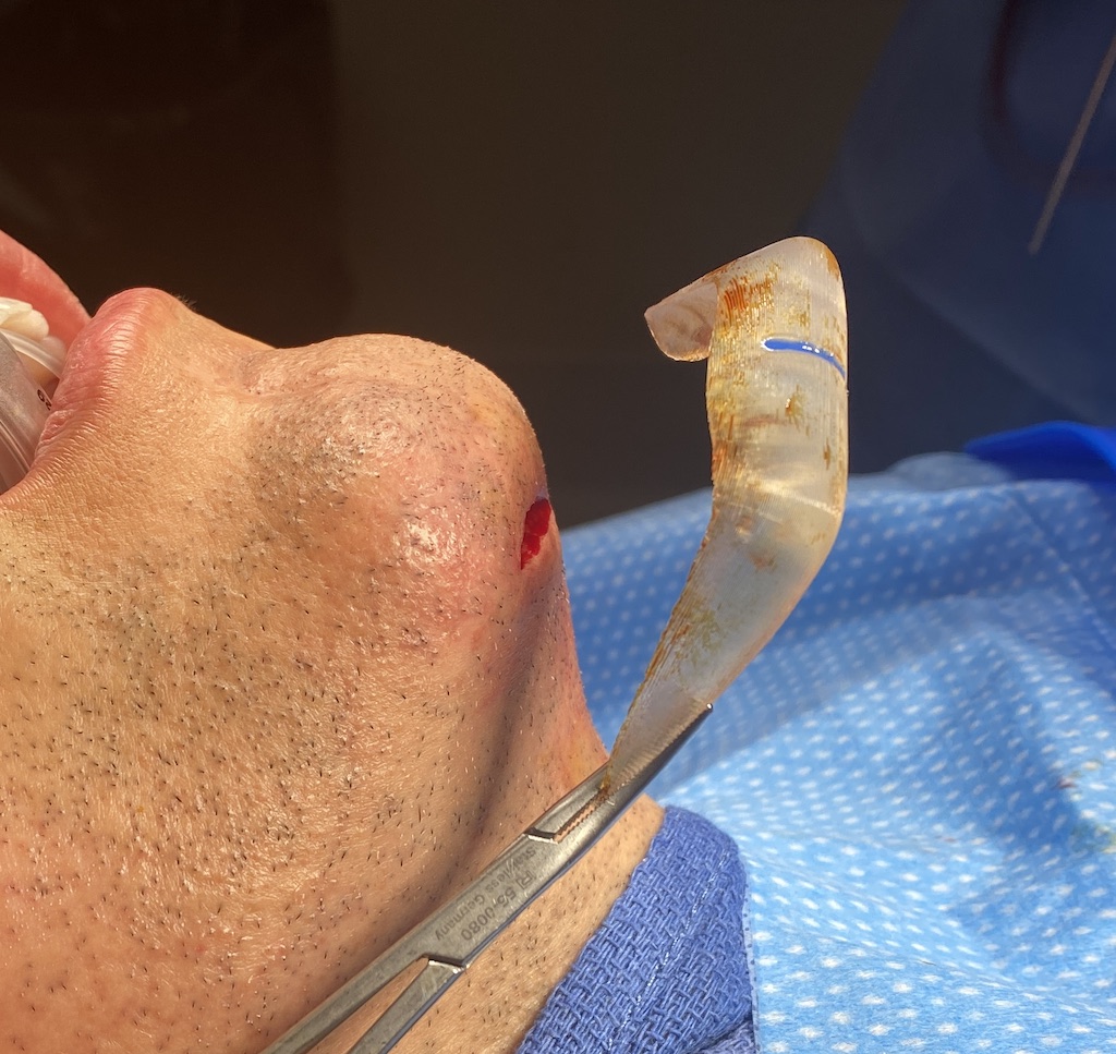 chin implant overlay intraop Dr Barry Eppley - Explore Plastic Surgery