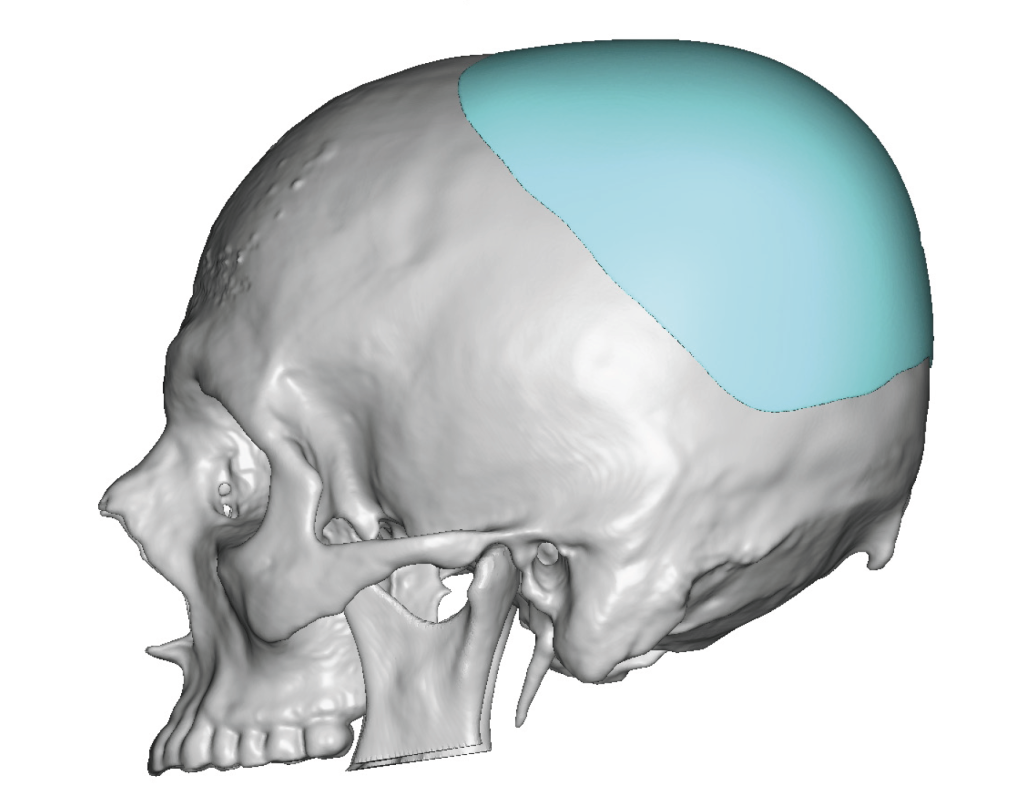 Plastic Surgery Case Study - Custom Skull Implant Augmentation for the ...