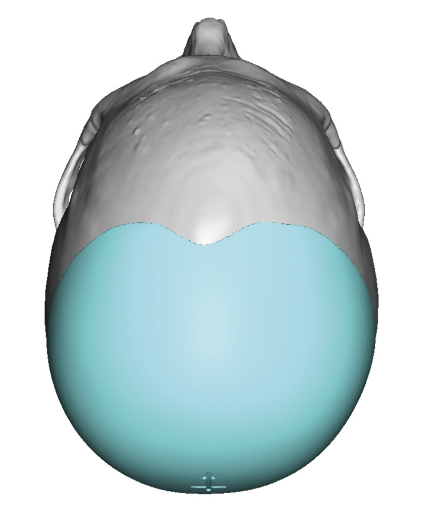 Plastic Surgery Case Study - Custom Skull Implant Augmentation for the ...