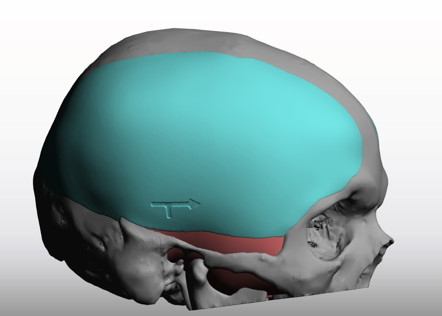 Plastic Surgery Case Study - Secondary Custom Posterior Temporal ...
