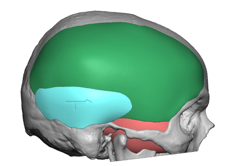 Plastic Surgery Case Study - Secondary Custom Posterior Temporal ...