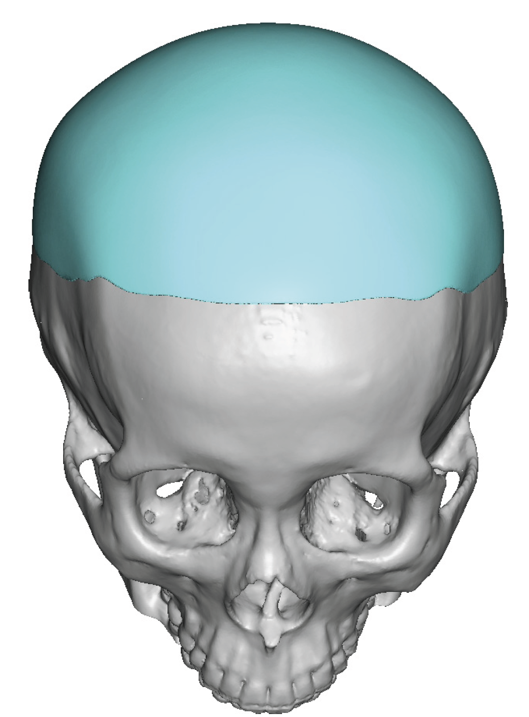 Plastic Surgery Case Study - The Aesthetic Advantages of a Custom Skull ...