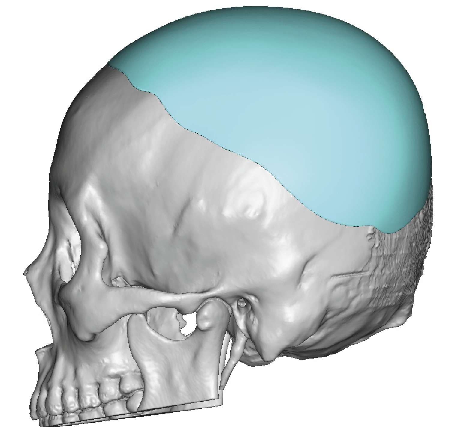 Plastic Surgery Case Study - The Aesthetic Advantages of a Custom Skull ...