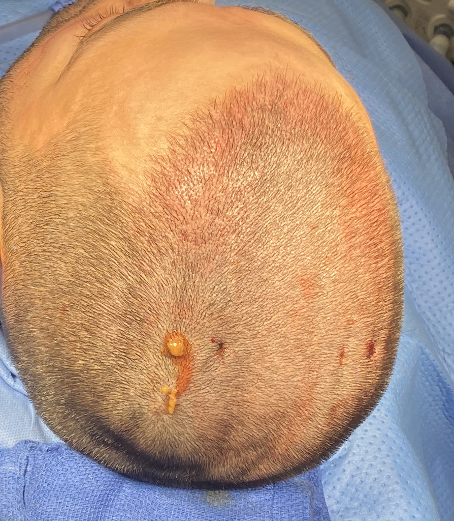Plastic Surgery Case Study - The Trearment of Scalp Cutis Verticis ...