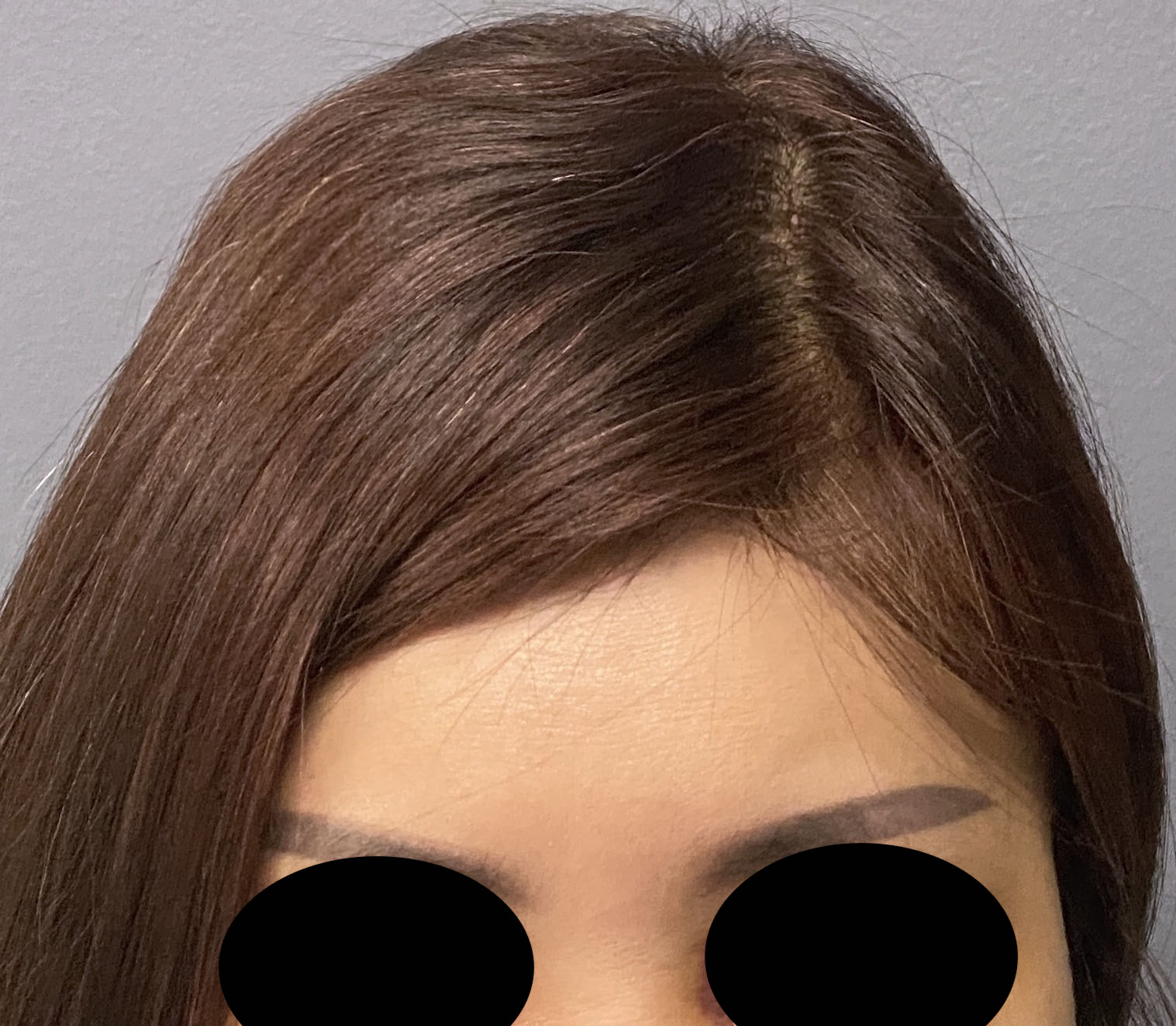 Plastic Surgery Case Study - Custom Skull Implant After PMMA Bone ...