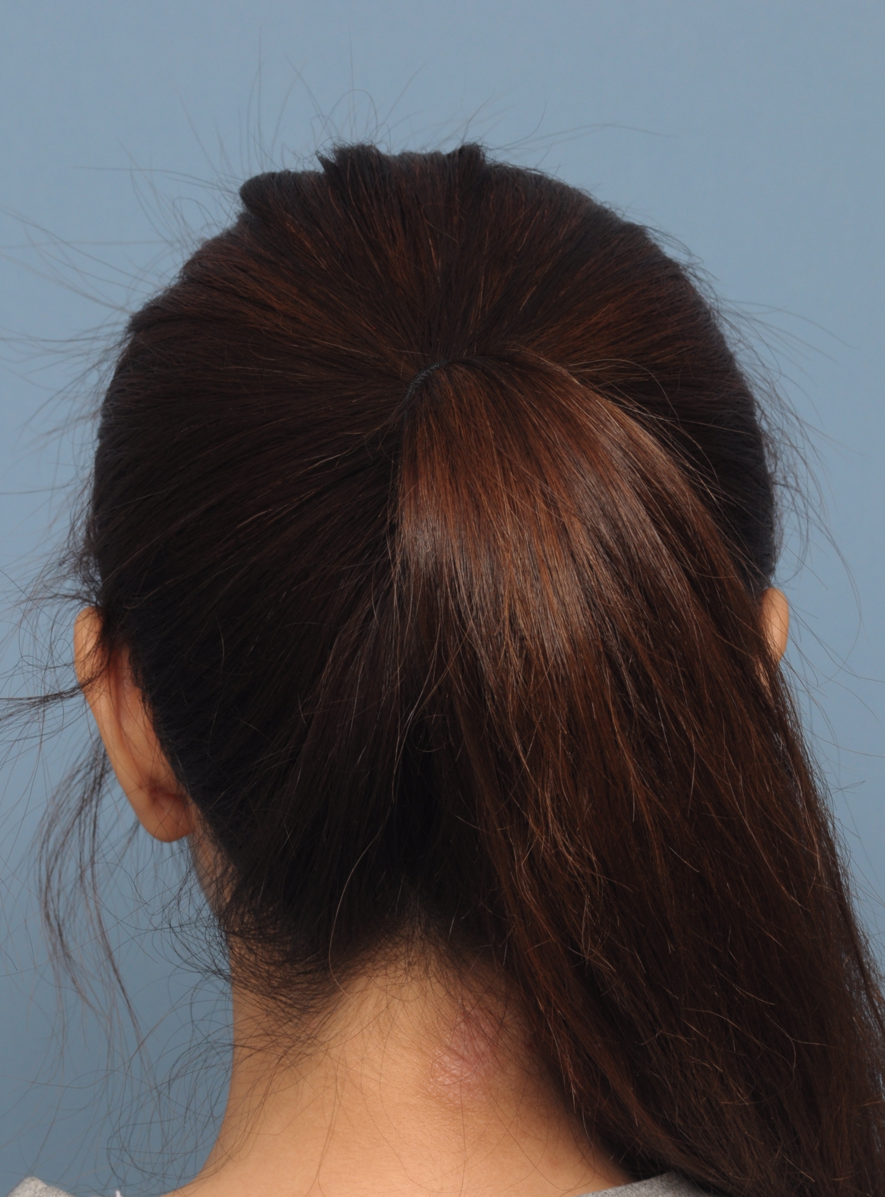 Plastic Surgery Case Study - Custom Skull Implant After PMMA Bone ...