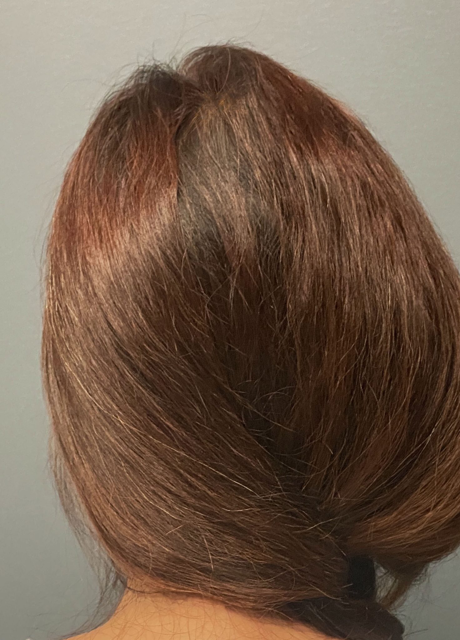 Plastic Surgery Case Study - Custom Skull Implant After PMMA Bone ...