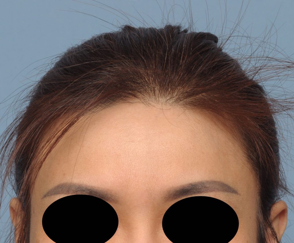 Plastic Surgery Case Study - Custom Skull Implant After PMMA Bone ...