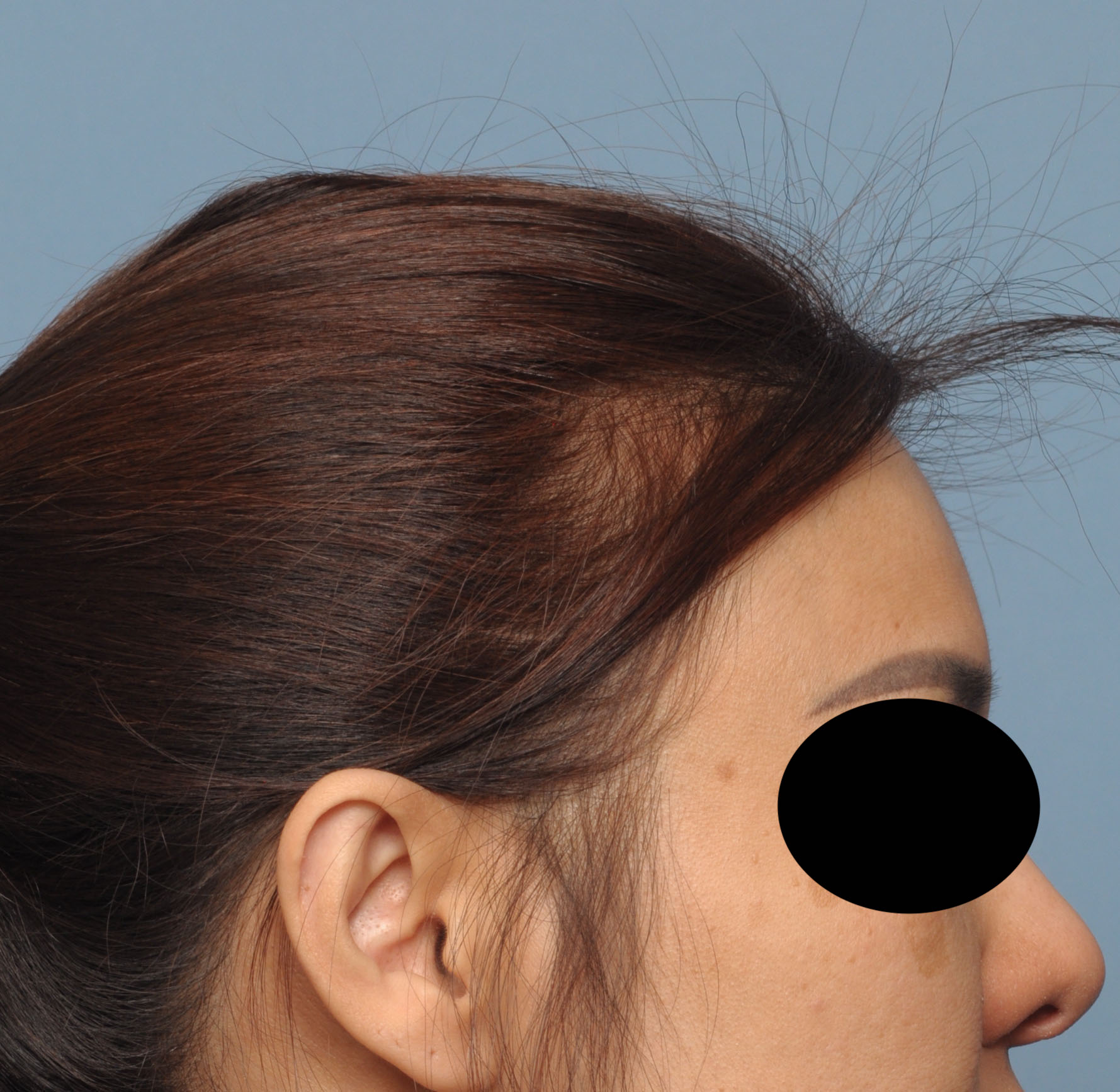 Plastic Surgery Case Study - Custom Skull Implant After PMMA Bone ...