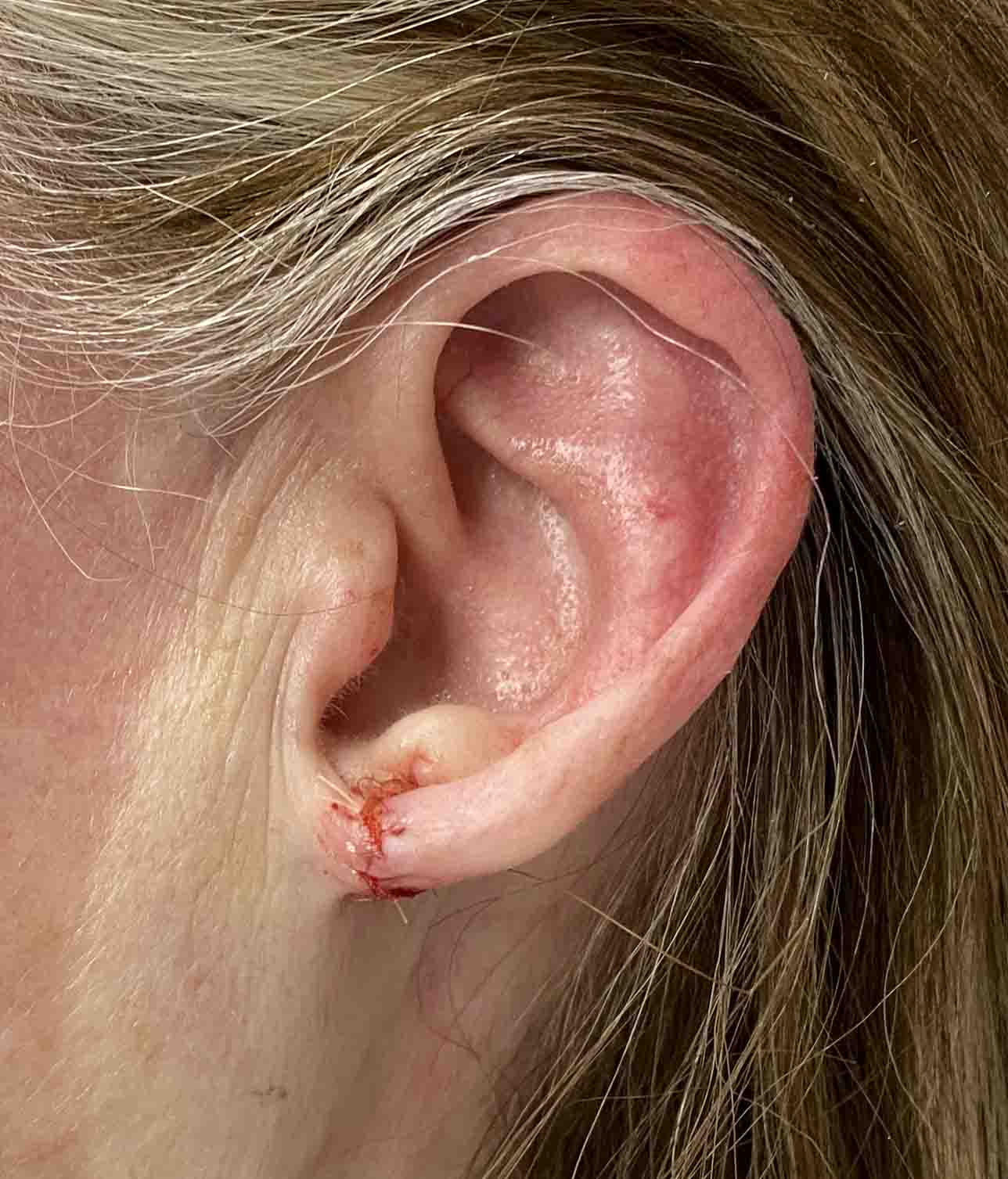 female earlobe repair dr barry eppley - Explore Plastic Surgery