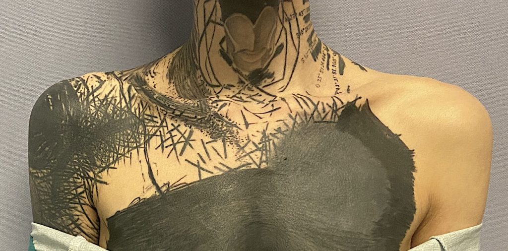 Plastic Surgery Case Study - Staged Shoulder Narrowing by Unilateral ...