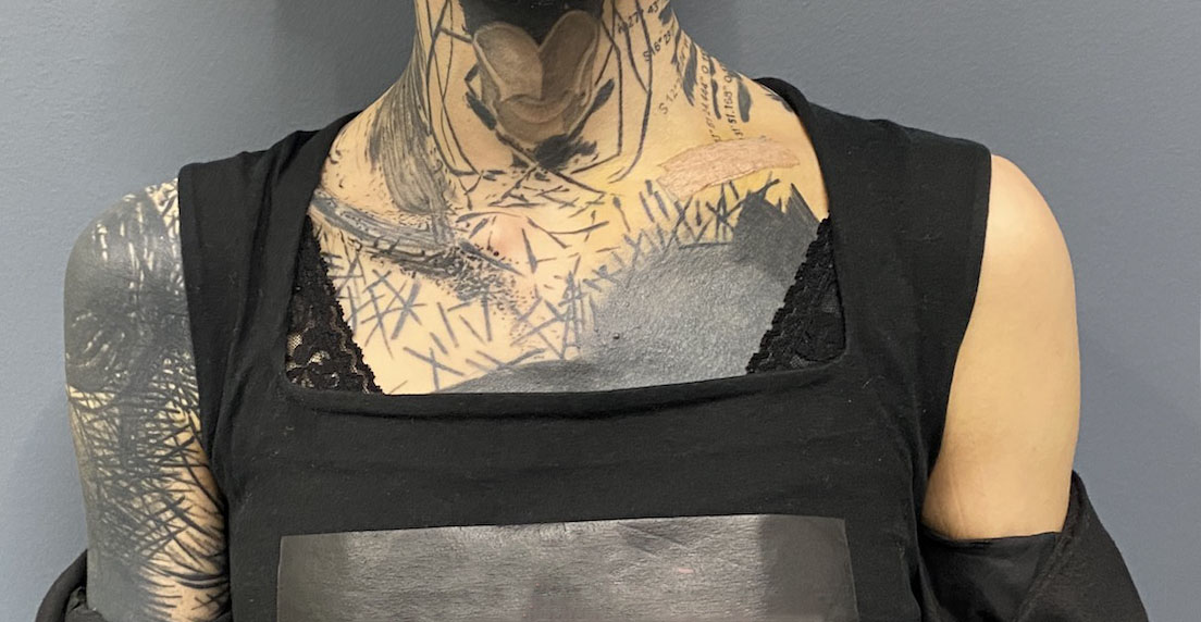 Plastic Surgery Case Study - Staged Shoulder Narrowing by Unilateral ...